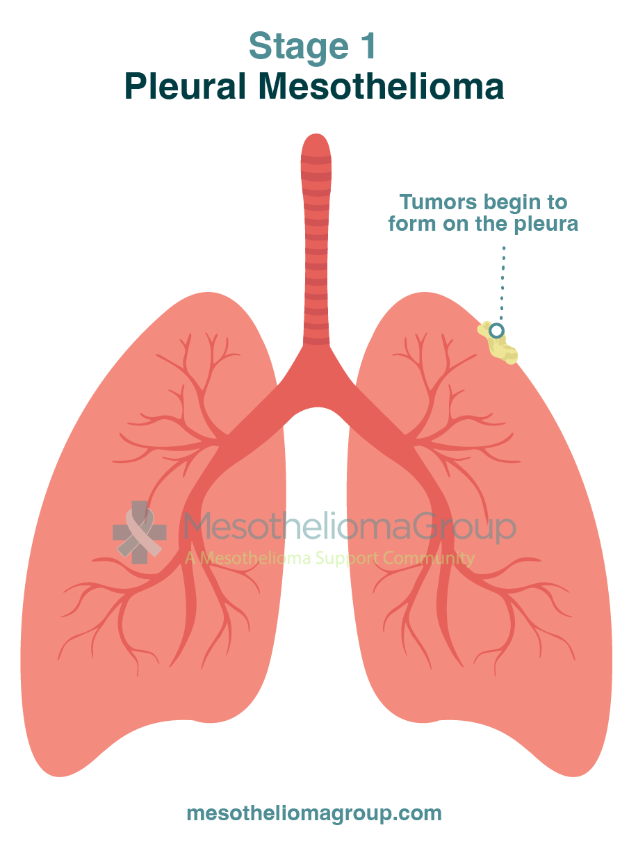 Mesothelioma Stages Breaking Down The 4 Stages